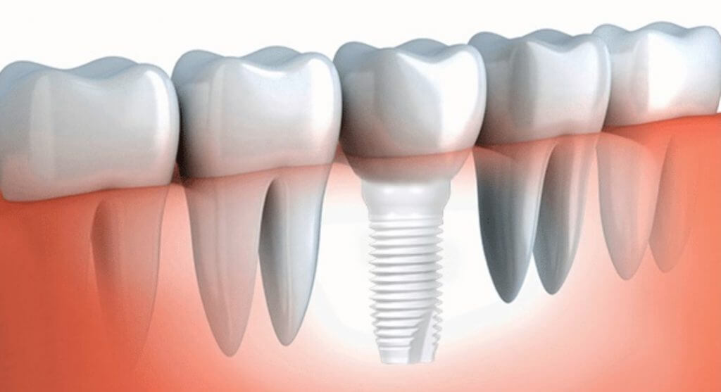 Implante con Zirconio en Barcelona - Implantosofia